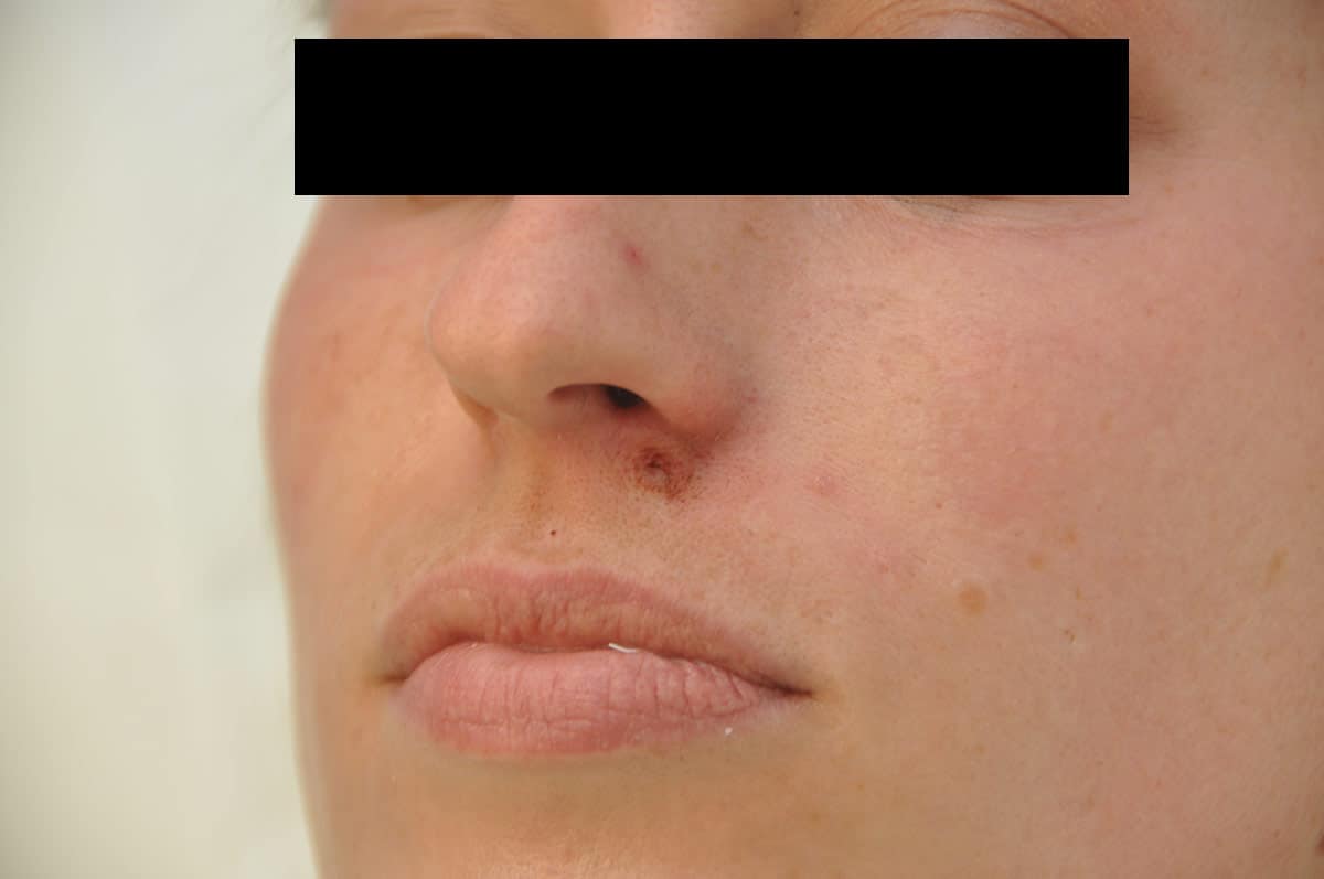 Mole / Growth Removal Archives - Skin & Laser Surgery Center of New England